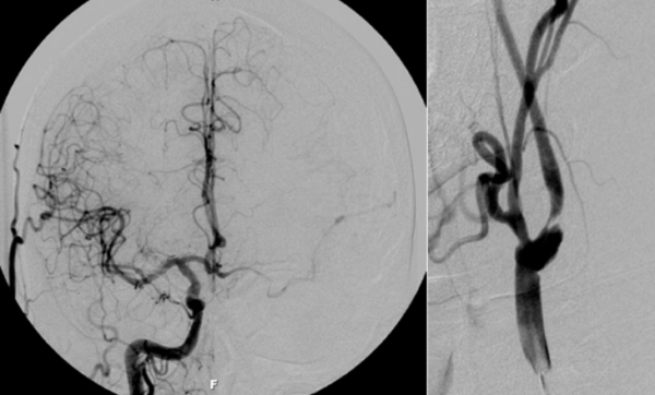Carotid and Cerebral Angiography - California Center for ...
