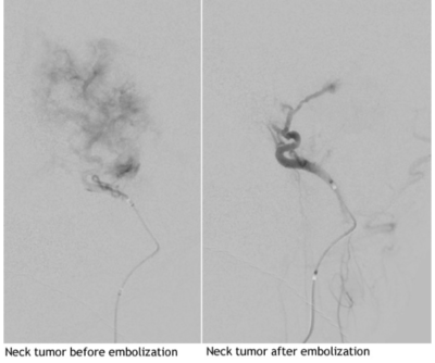 Head & Neck Tumors - California Center for Neurointerventional Surgery