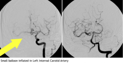 Temporary Balloon Occlusion Testing - California Center for ...